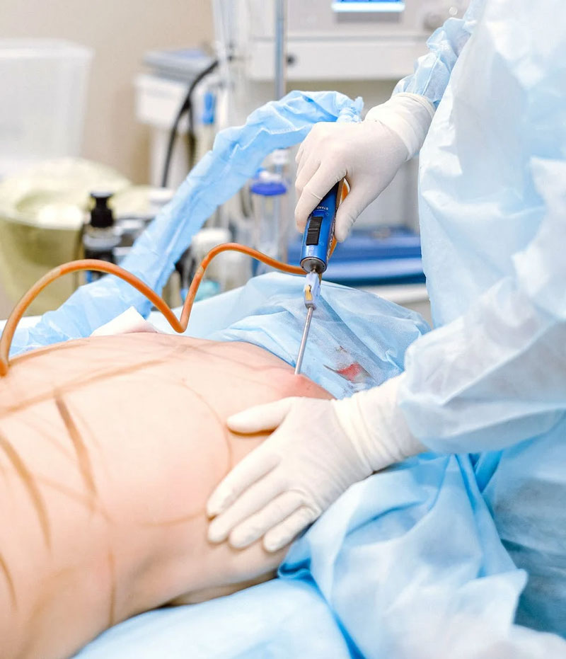 Important Things To Know Before Undergoing Liposuction Procedure