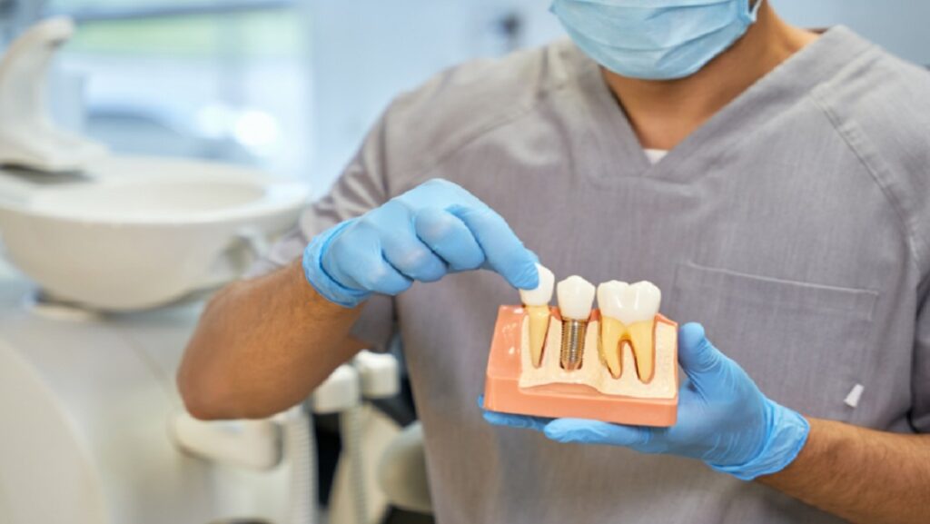 The Benefits of Opting for Dental Implants Over Other Treatm