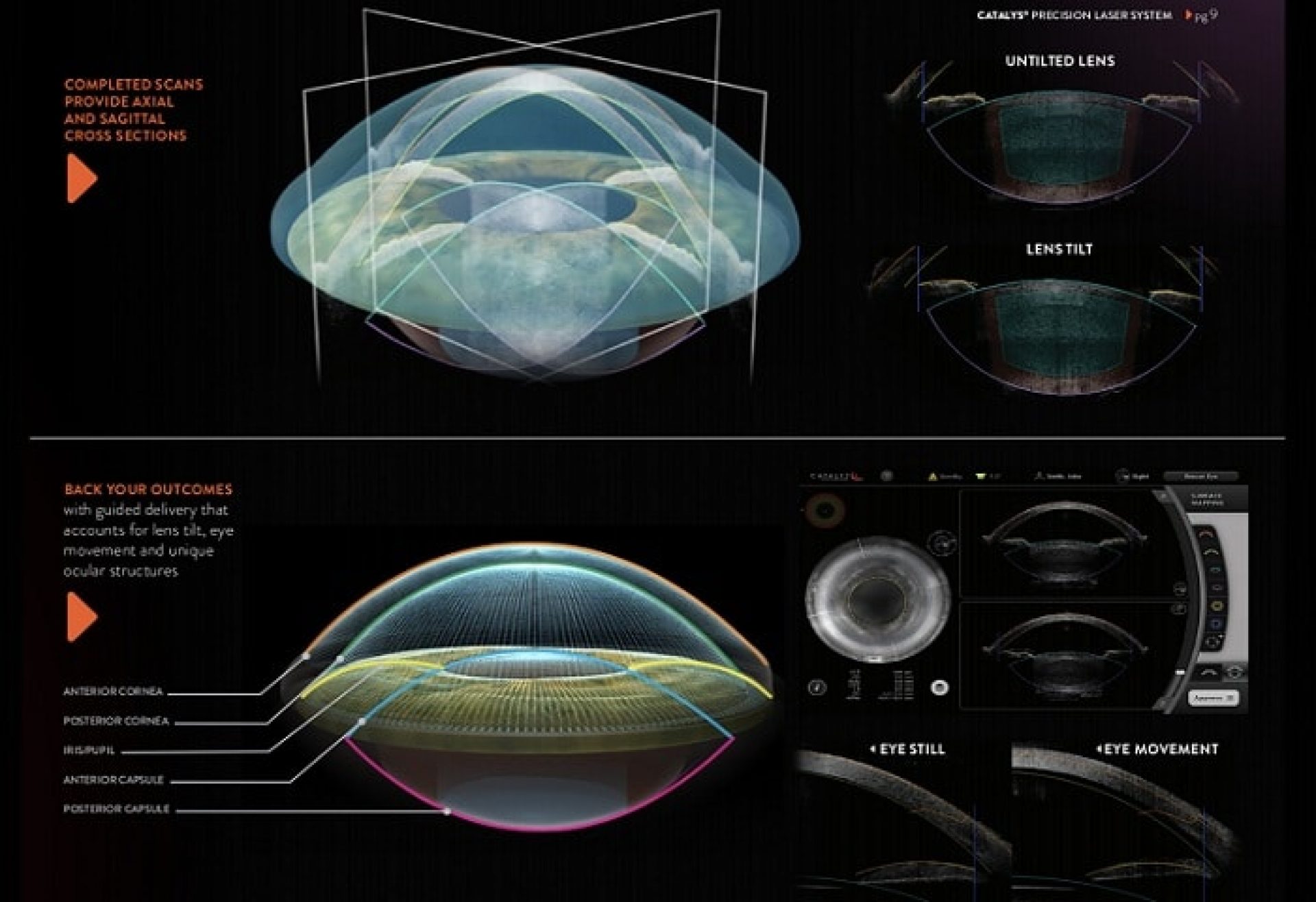 Trained by a Robot: How my Femtosecond Laser Makes Me a Better Cataract ...