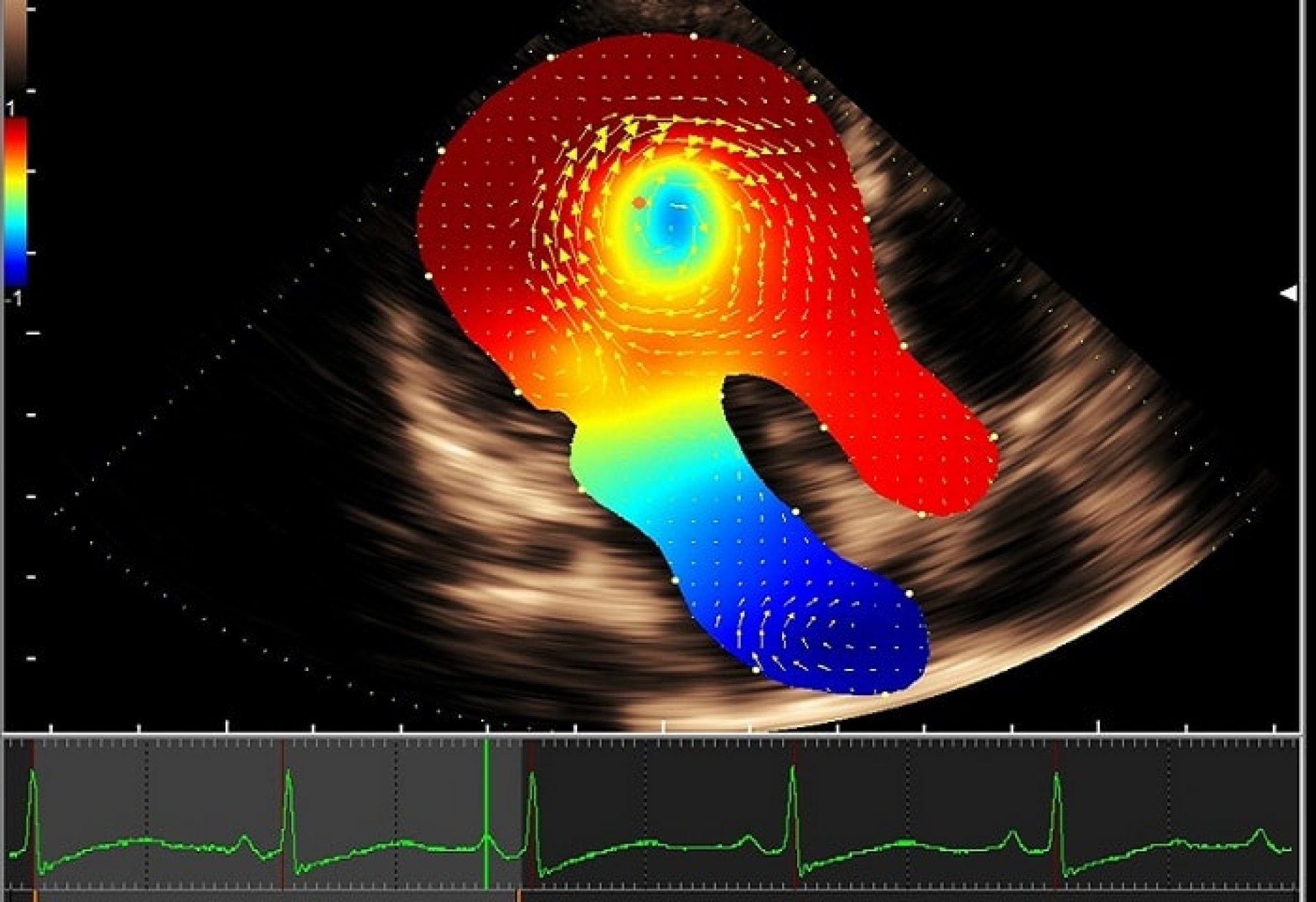 Hitachi Medical Systems introduced the next intelligent Vector Flow Mapping