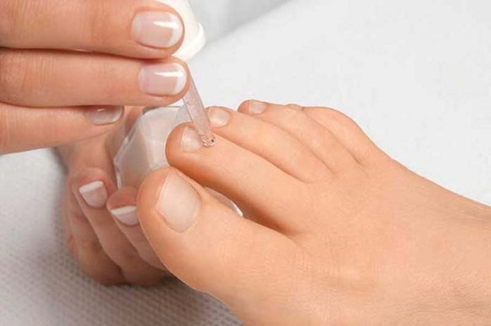 How To Get Rid Of Toenail Fungus With Bleach