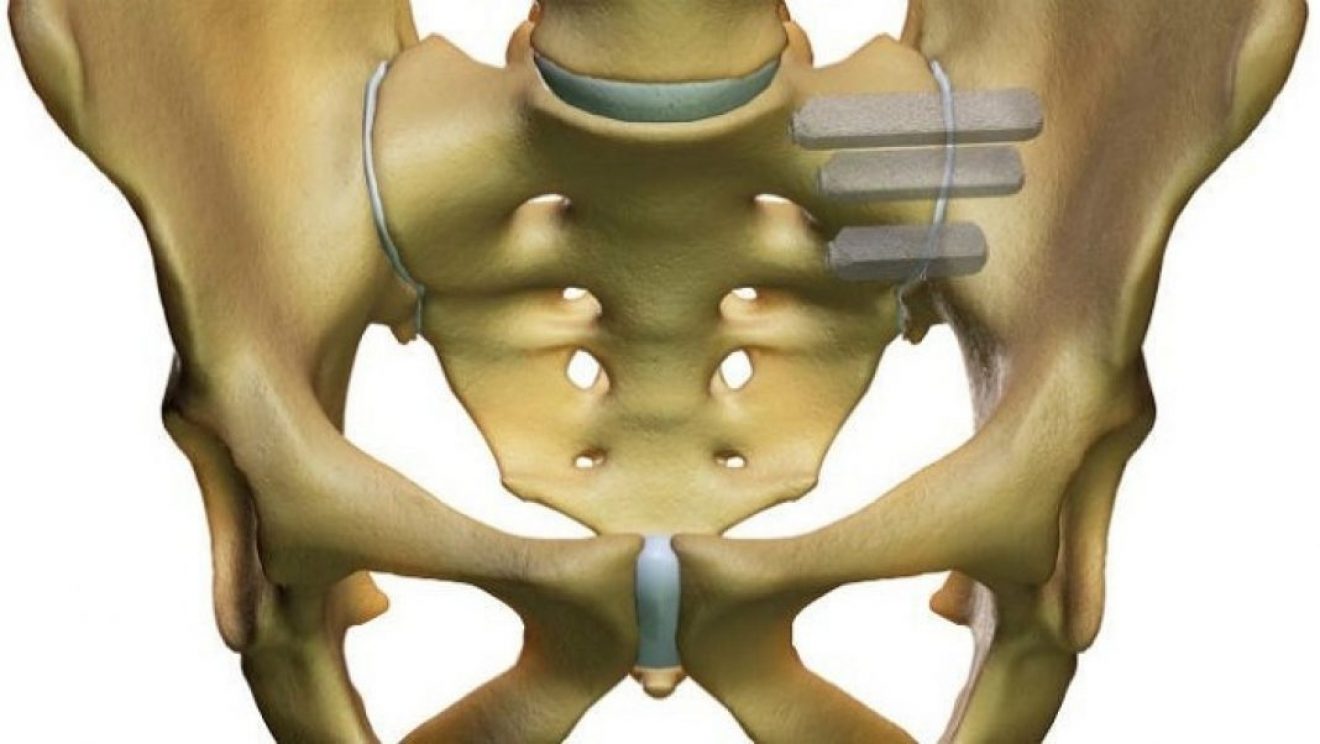 SI-BONE Announces FDA Clearance of iFuse Bedrock Novel Spinopelvic ...